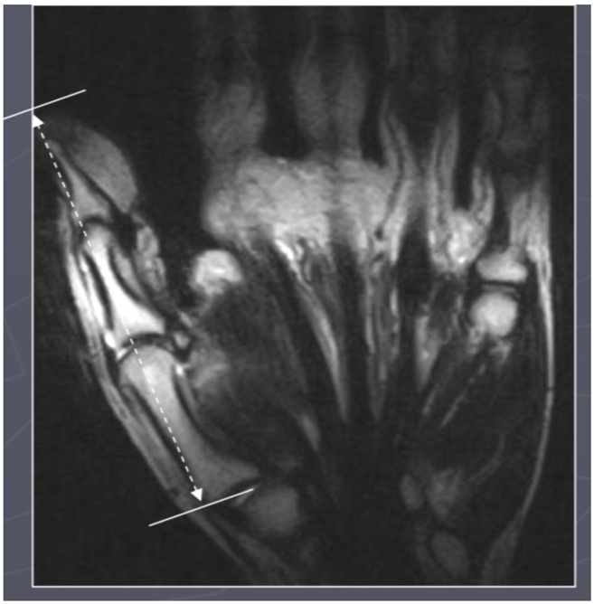 MSK MRI Protocol (Hand or Wrist W WO )