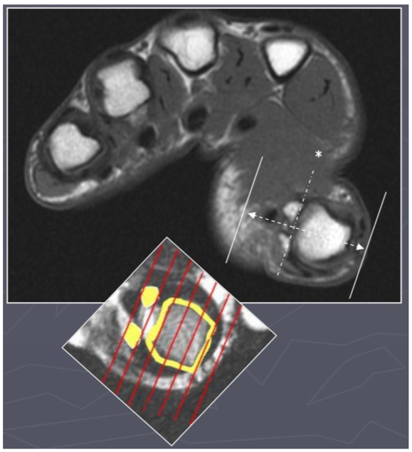 MSK MRI Protocol (Hand or Wrist W WO )