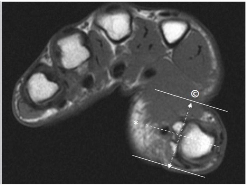 MSK MRI Protocol (Hand or Wrist W WO )