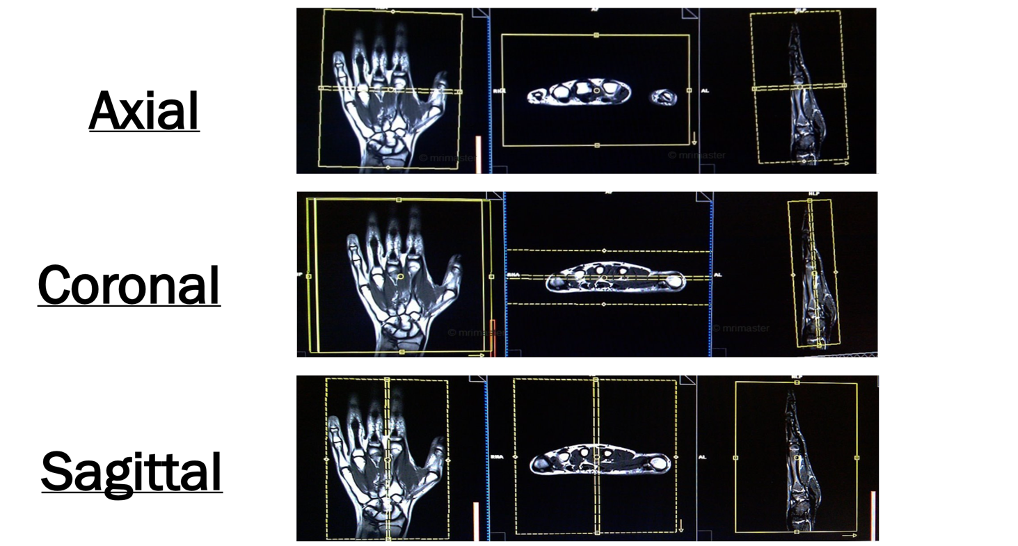 MSK MRI Protocol (Hand or Wrist W WO )