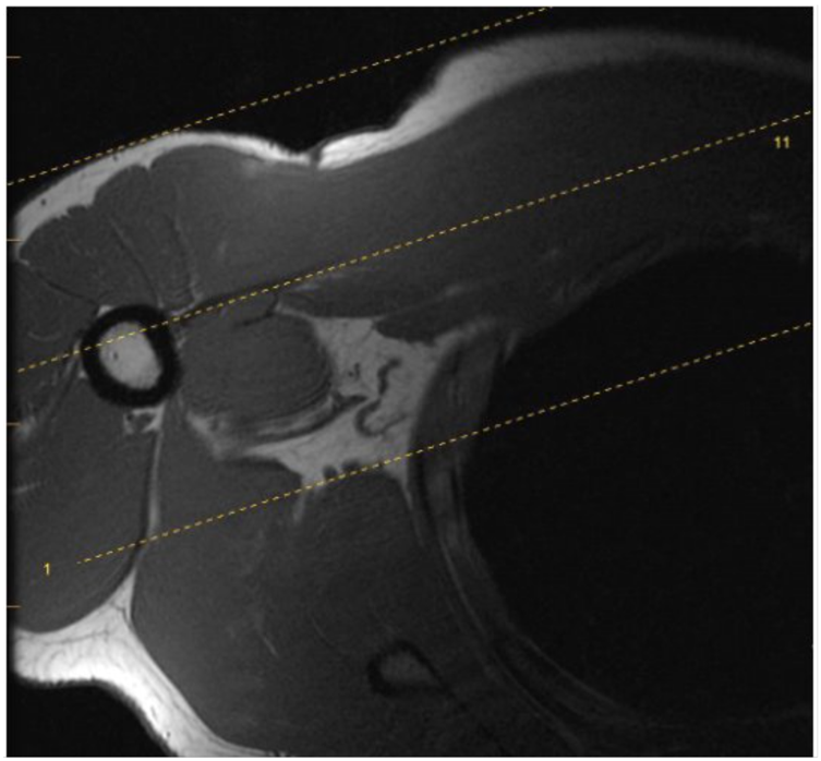 MSK MRI Protocol (Pectoralis )