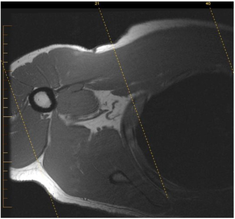MSK MRI Protocol (Pectoralis )