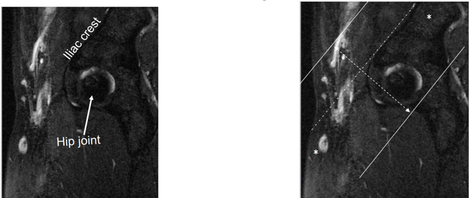 MSK MRI Protocol (Sports Hernia )