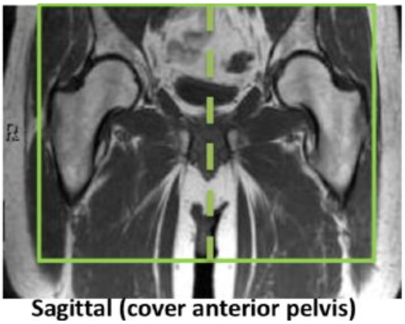 MSK MRI Protocol (Sports Hernia )