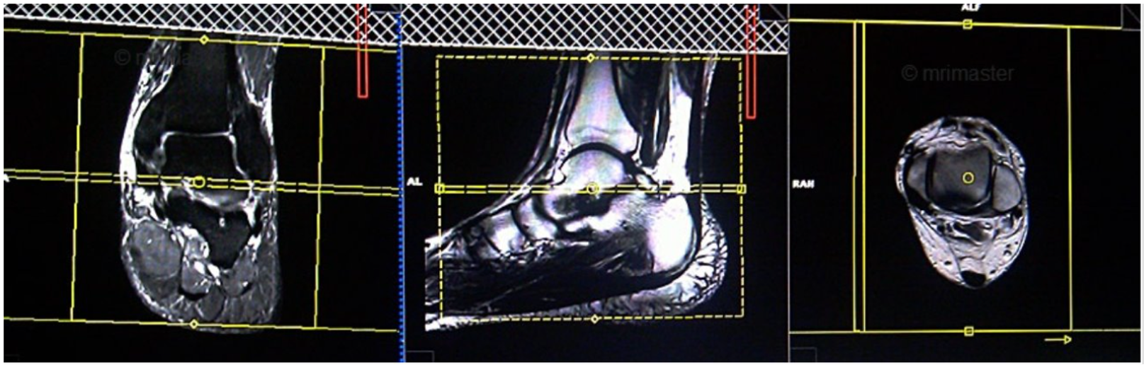 MSK MRI Protocol(Ankle W-WO)