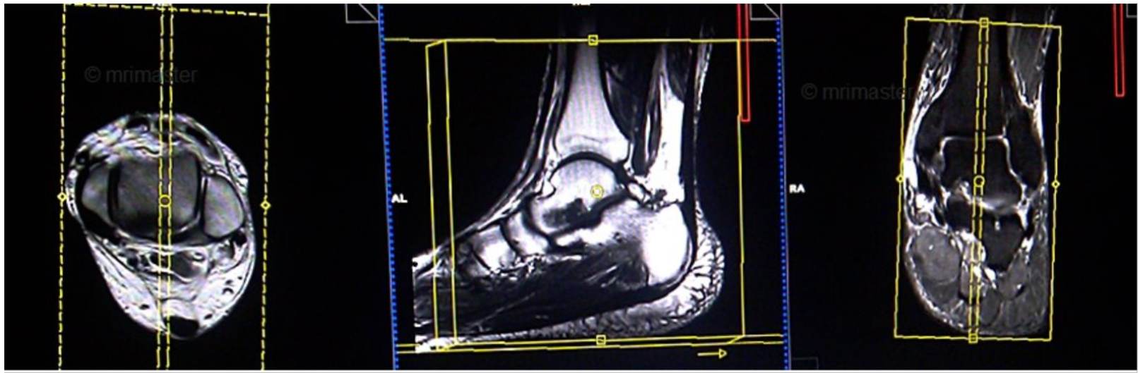 MSK MRI Protocol(Ankle W-WO)