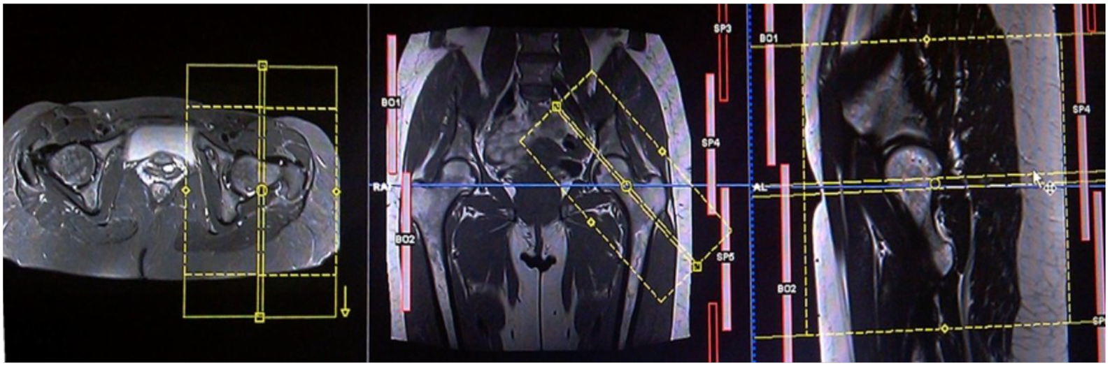 MSK MRI Protocol(Hip W-WO )