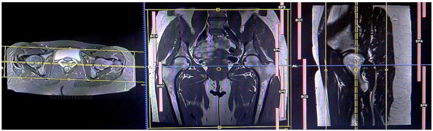 MSK MRI Protocol(Hip W-WO )