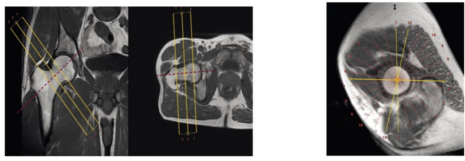 MSK MRI Protocol(Hip W-WO )