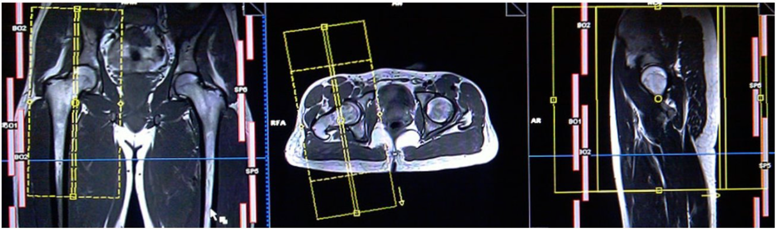 MSK MRI Protocol(Hip W-WO )