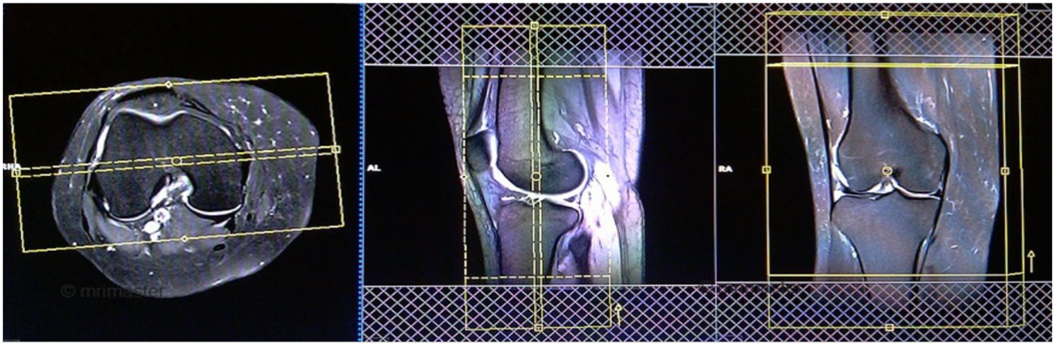 MSK MRI Protocol (Knee W-WO)