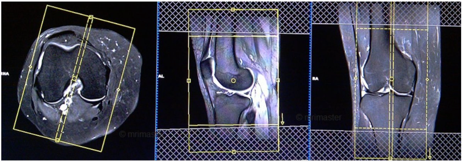 MSK MRI Protocol (Knee W-WO)