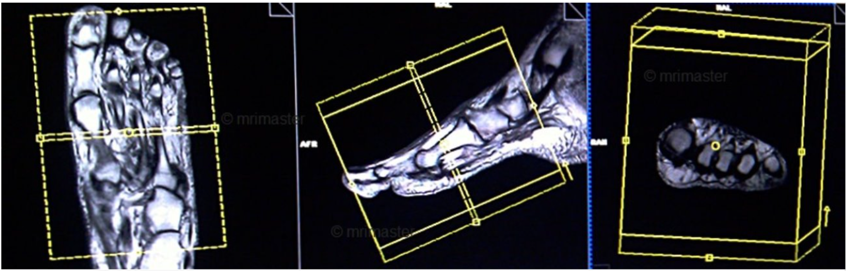 MSK MRI Protocol-Foot(Non-Osteo)