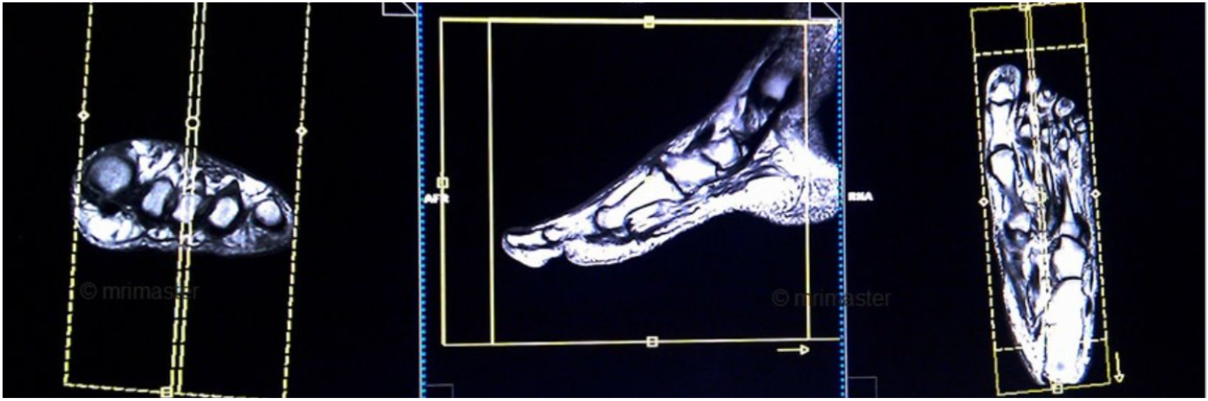 MSK MRI Protocol-Foot(Non-Osteo)