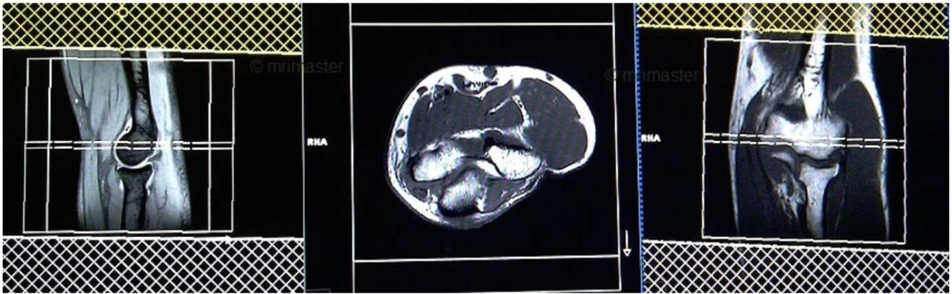 MSK MRI Protocol (Elbow W-WO)