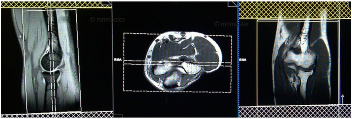 MSK MRI Protocol (Elbow W-WO)
