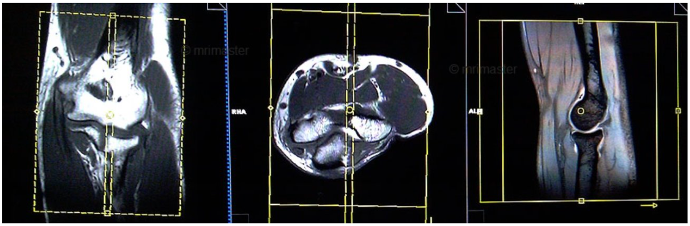 MSK MRI Protocol (Elbow W-WO)
