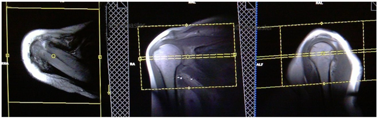 MSK MRI Protocol (Shoulder MRI)